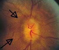 Medicine Decoded: Various Lines in Ophthalmology